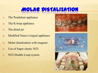 Orthodontic class 2 div 2 | PPTX