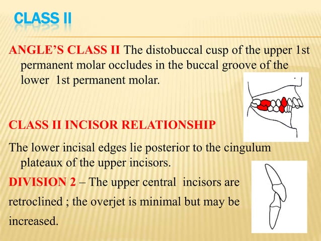 Orthodontic class 2 div 2 | PPT