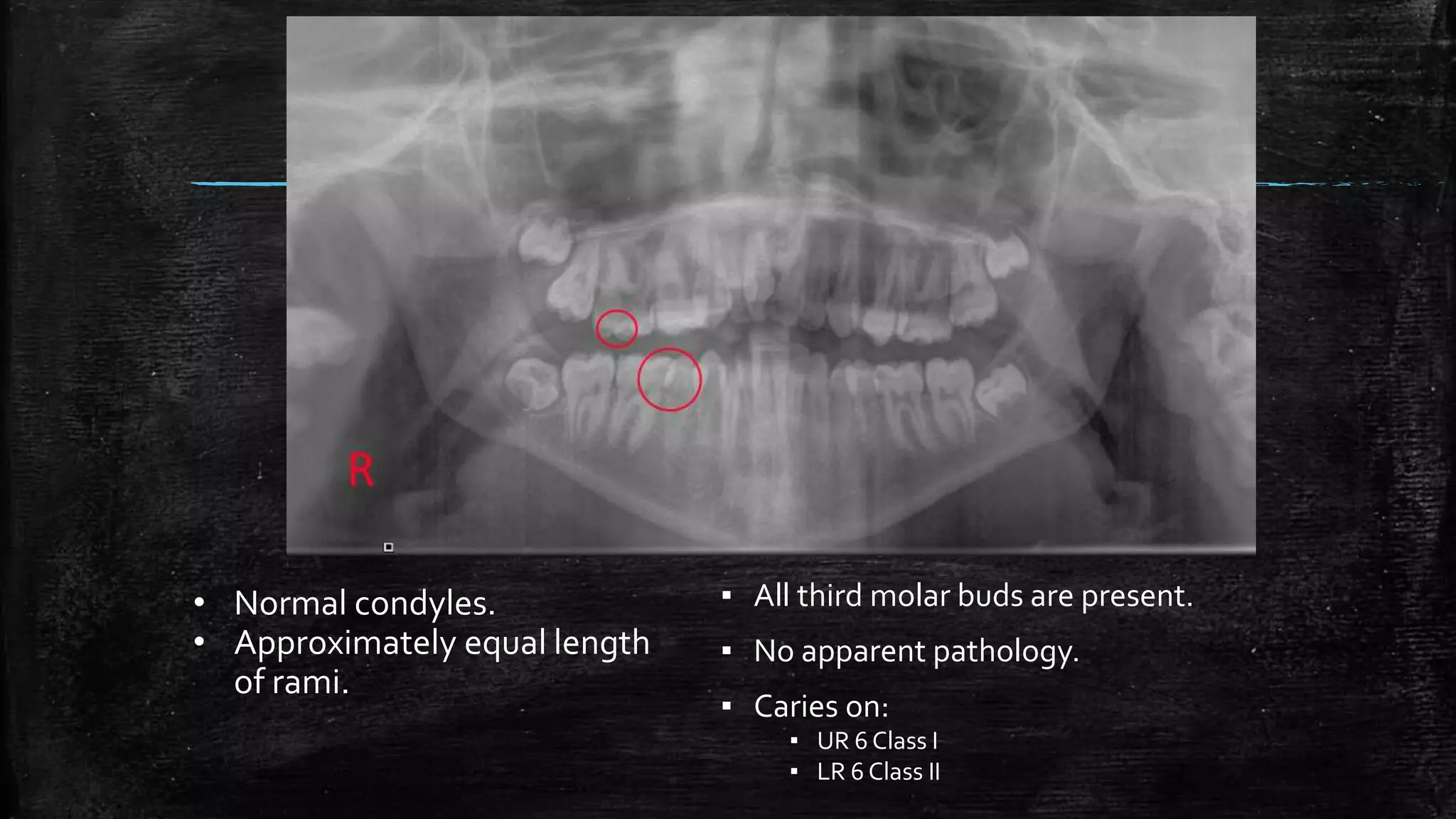 Orthodontic clinical case presentation - Dr shareef alshanableh | PPTX