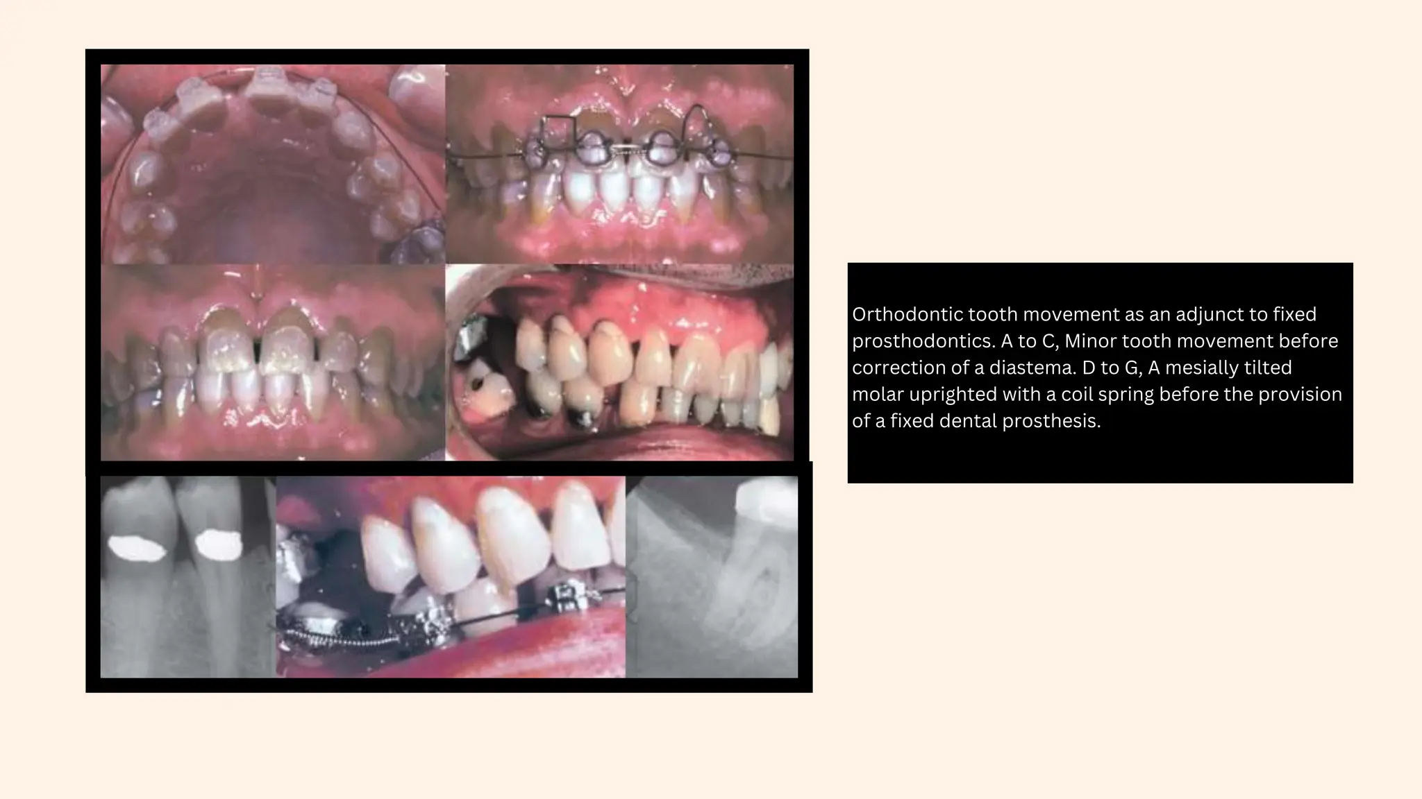 Orthodontic Consideration In Fixed partial denture.pptx