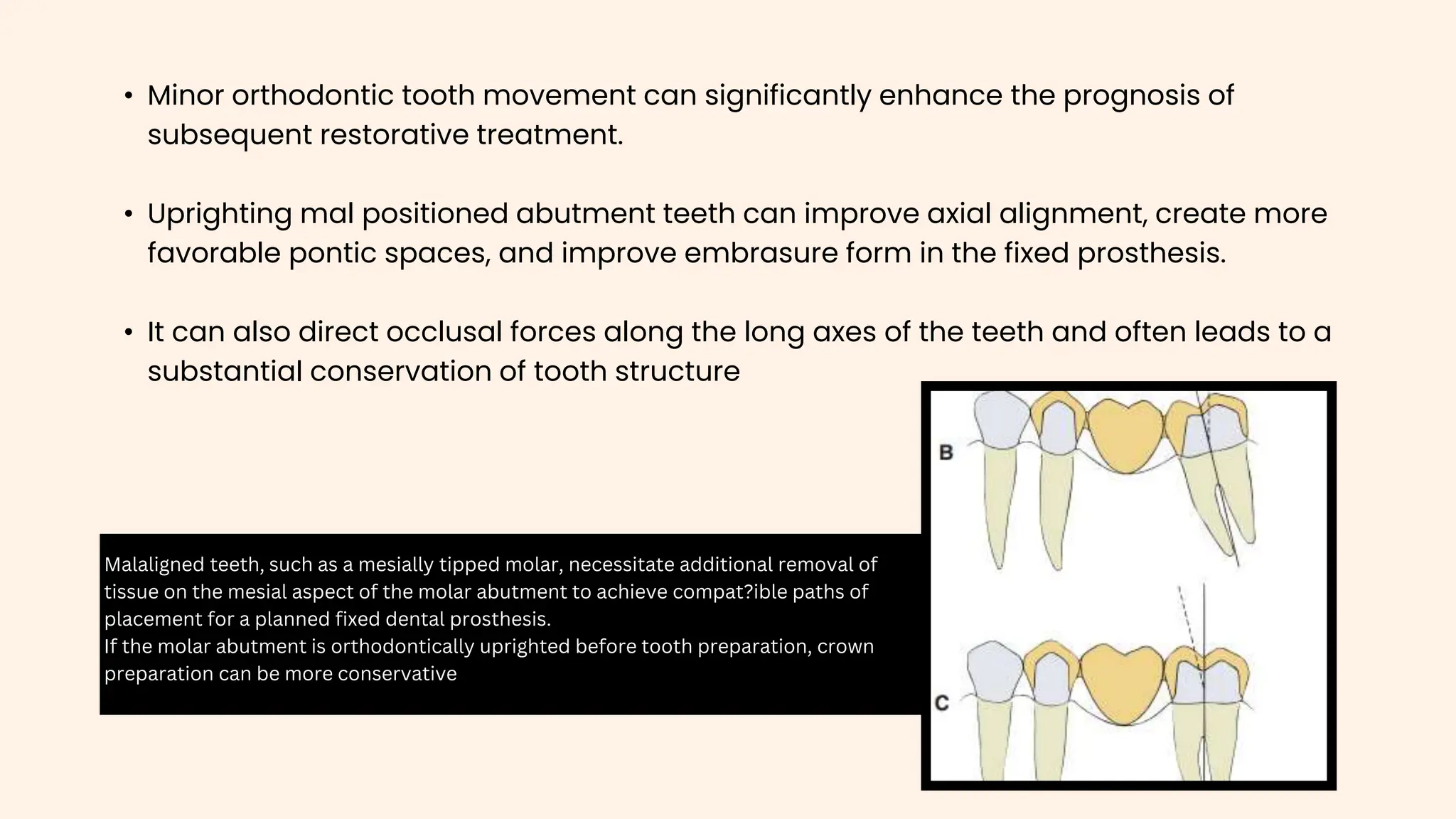 Orthodontic Consideration In Fixed partial denture.pptx