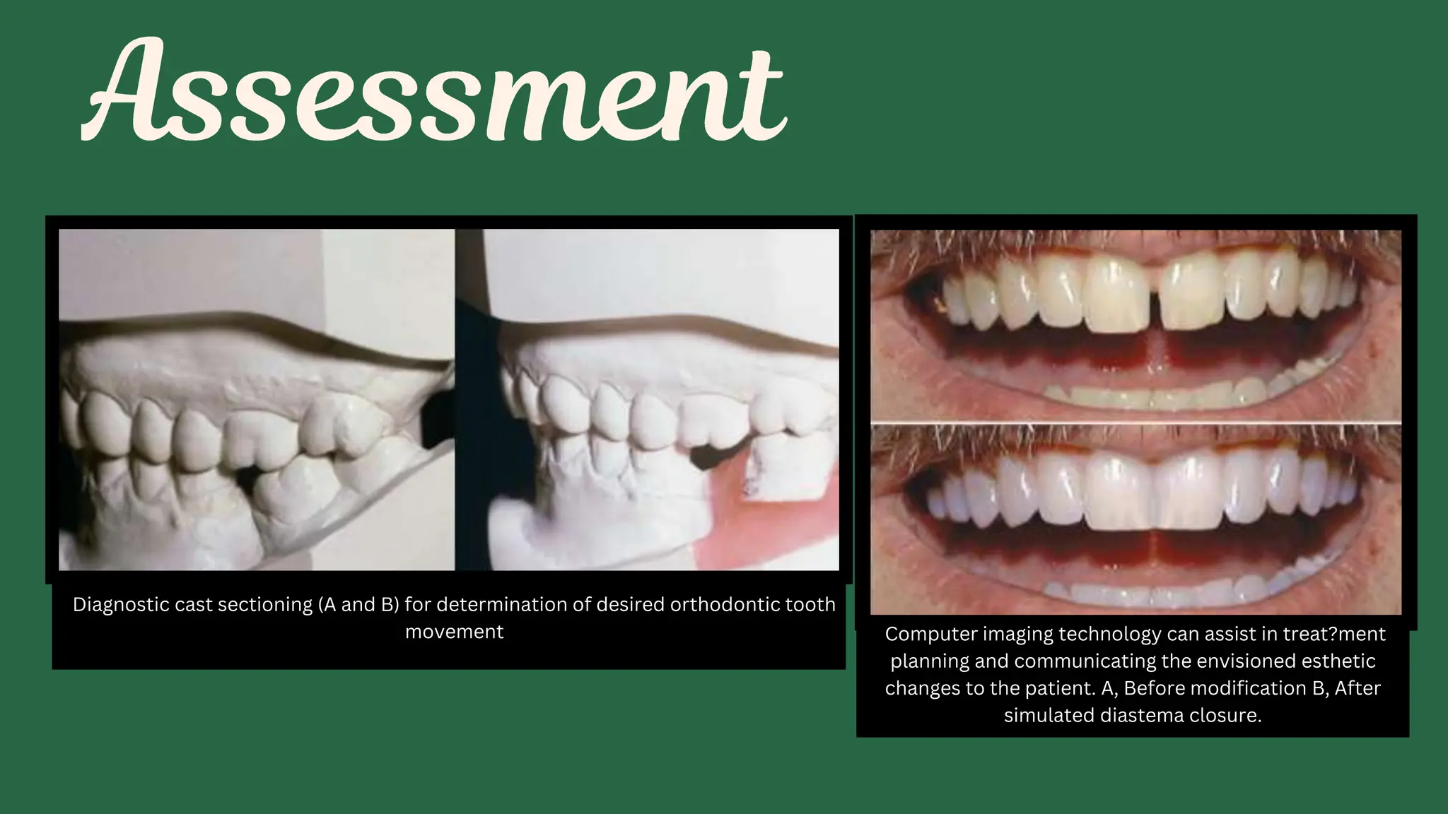 Orthodontic Consideration In Fixed partial denture.pptx