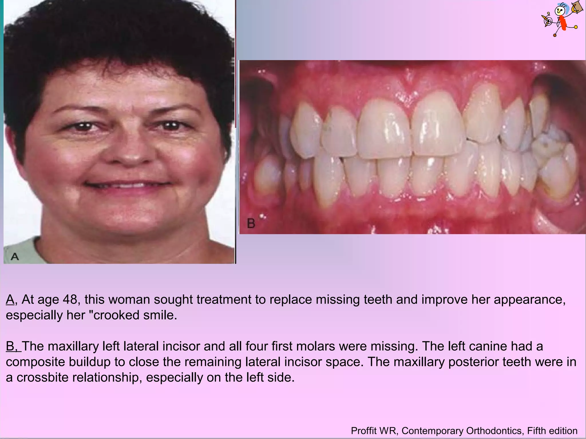 Orthodontic consideration of the old extraction site | PPT