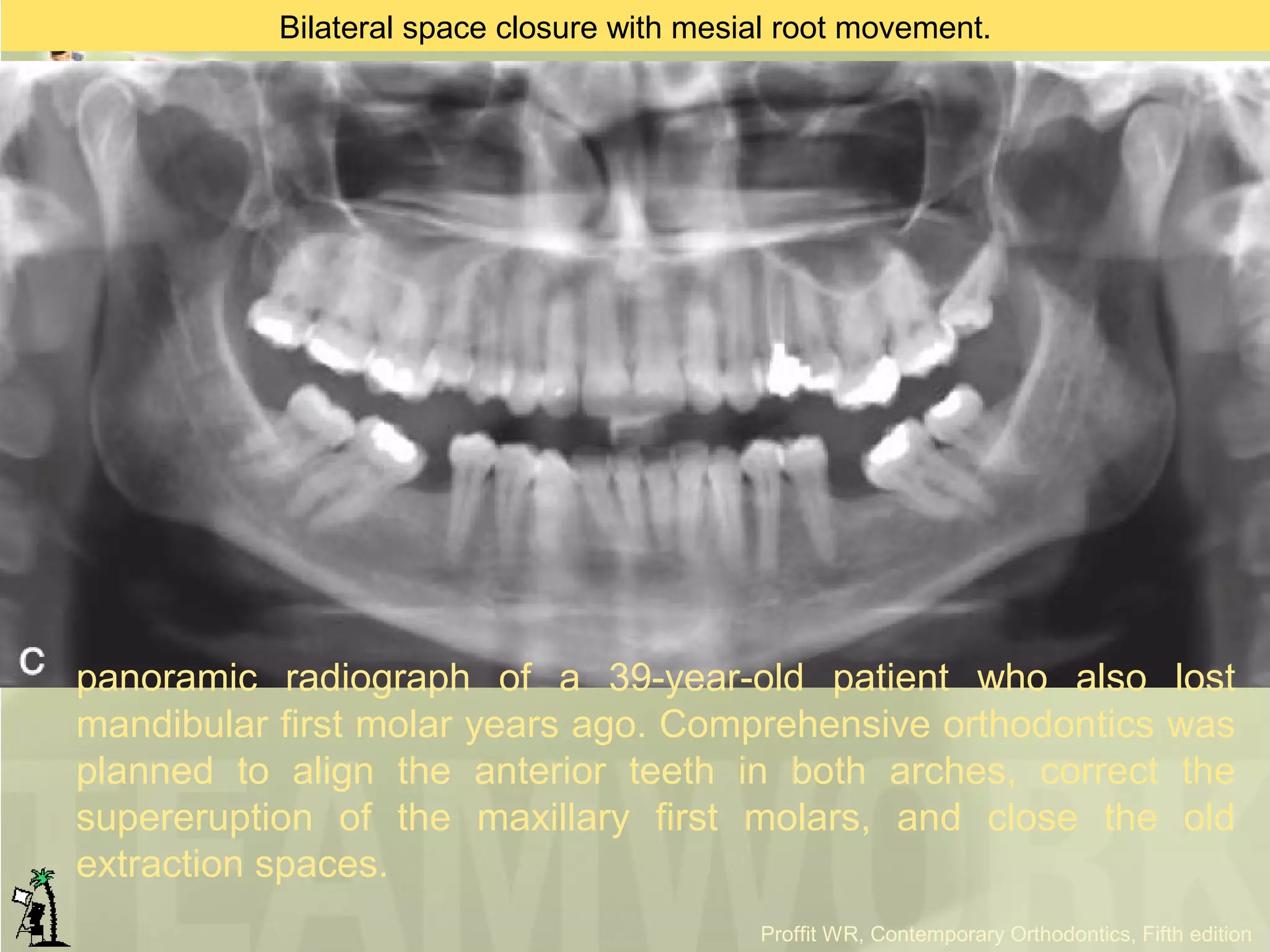 Orthodontic consideration of the old extraction site | PPT