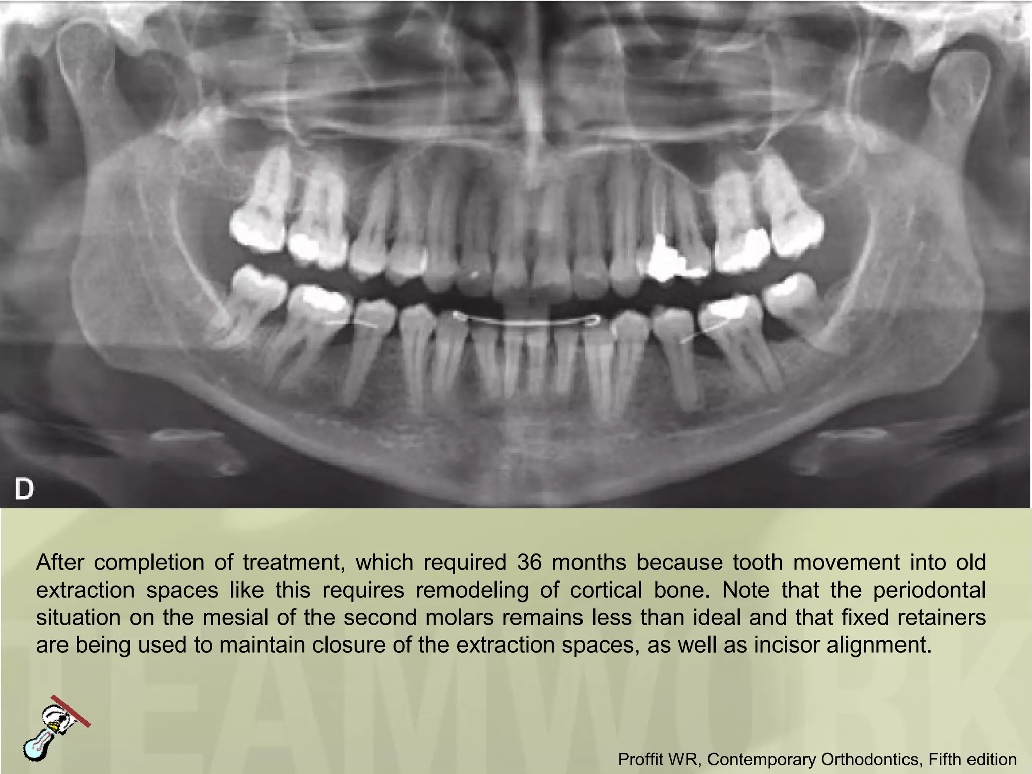 Orthodontic consideration of the old extraction site | PPT