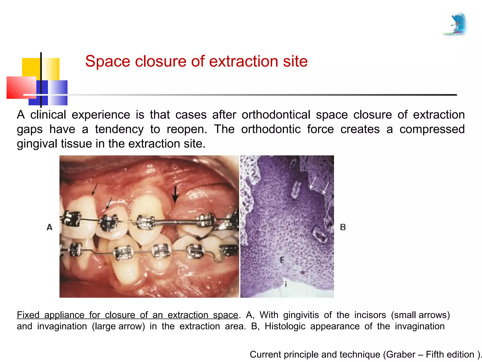 Orthodontic consideration of the old extraction site | PPT