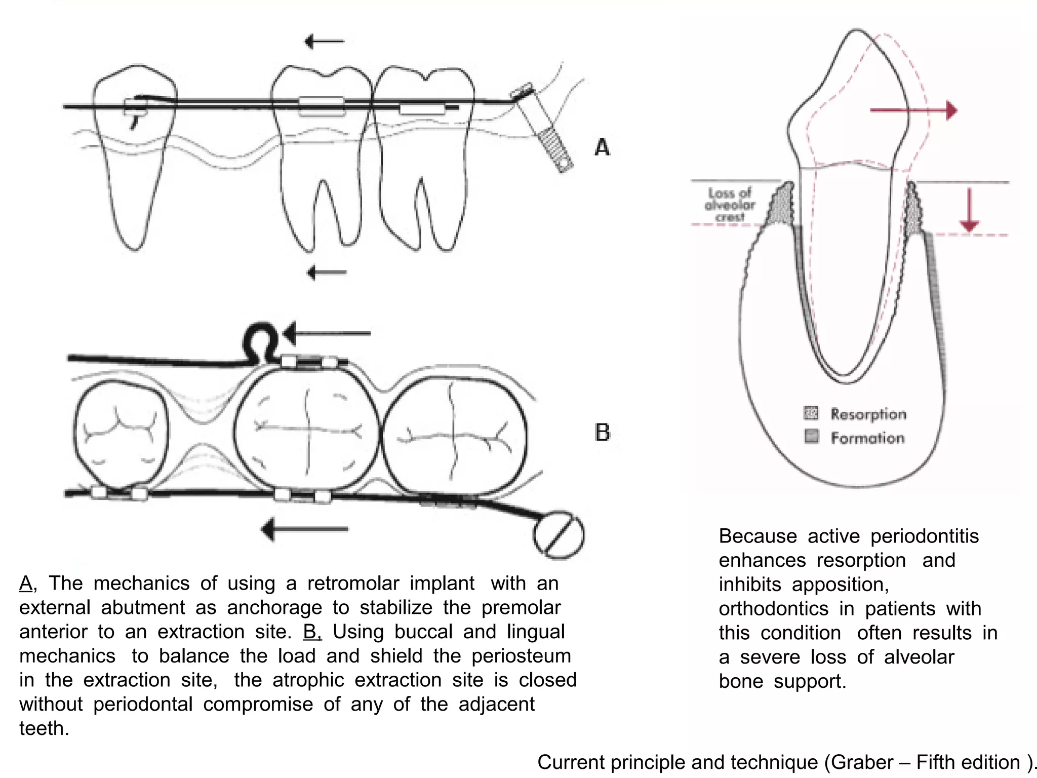 Orthodontic consideration of the old extraction site | PPT