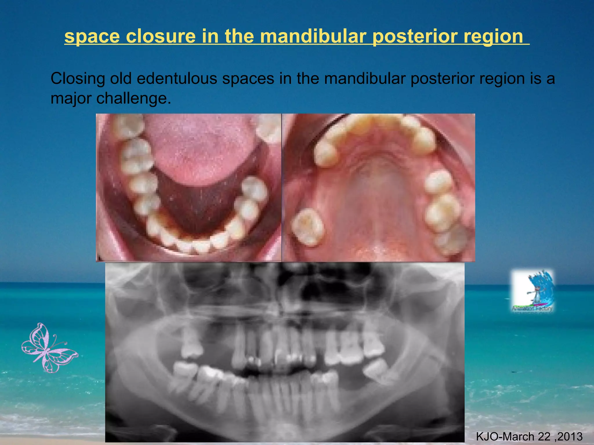 Orthodontic consideration of the old extraction site | PPT