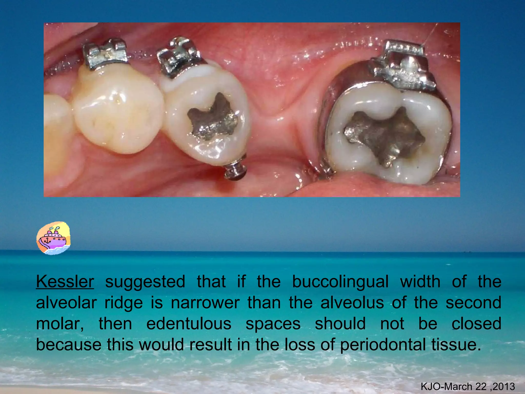 Orthodontic consideration of the old extraction site | PPT