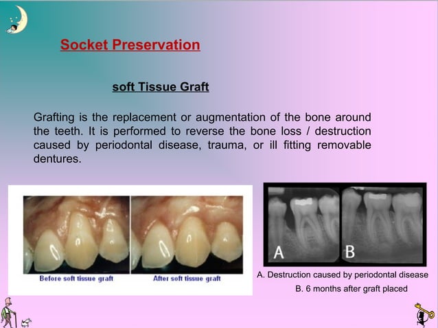 Orthodontic consideration of the old extraction site | PPT | Bone and ...
