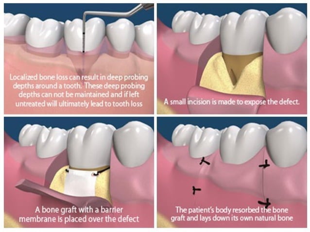 Orthodontic consideration of the old extraction site | PPT | Bone and ...