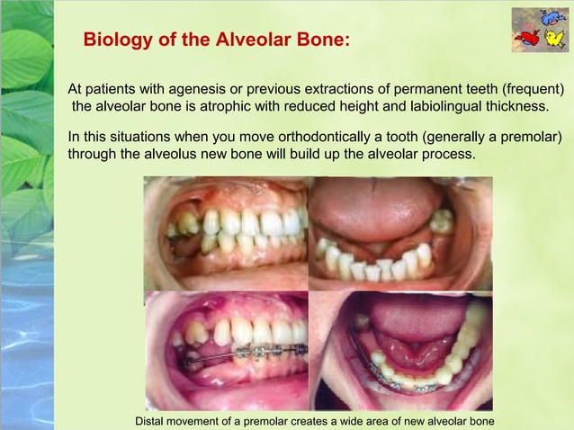 Orthodontic consideration of the old extraction site | PPT | Bone and ...