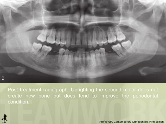 Orthodontic consideration of the old extraction site | PPT | Bone and ...