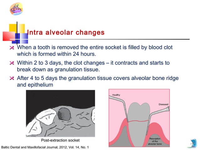 Orthodontic consideration of the old extraction site | PPT | Bone and ...