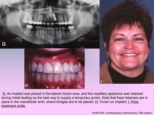 Orthodontic consideration of the old extraction site | PPT | Bone and ...