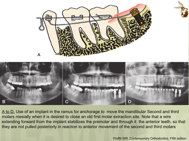 Orthodontic consideration of the old extraction site | PPT | Bone and ...