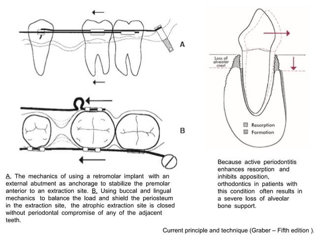 Orthodontic consideration of the old extraction site | PPT | Bone and ...