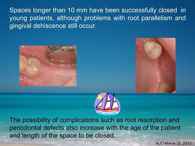 Orthodontic consideration of the old extraction site | PPT | Bone and ...