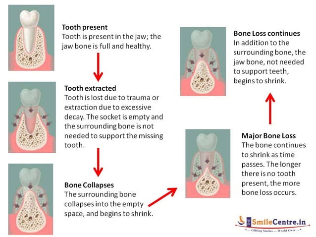 Orthodontic consideration of the old extraction site | PPT | Bone and ...