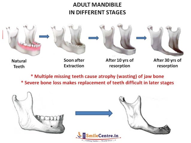 Orthodontic consideration of the old extraction site | PPT | Bone and ...