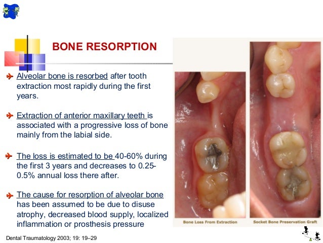 Orthodontic consideration of the old extraction site