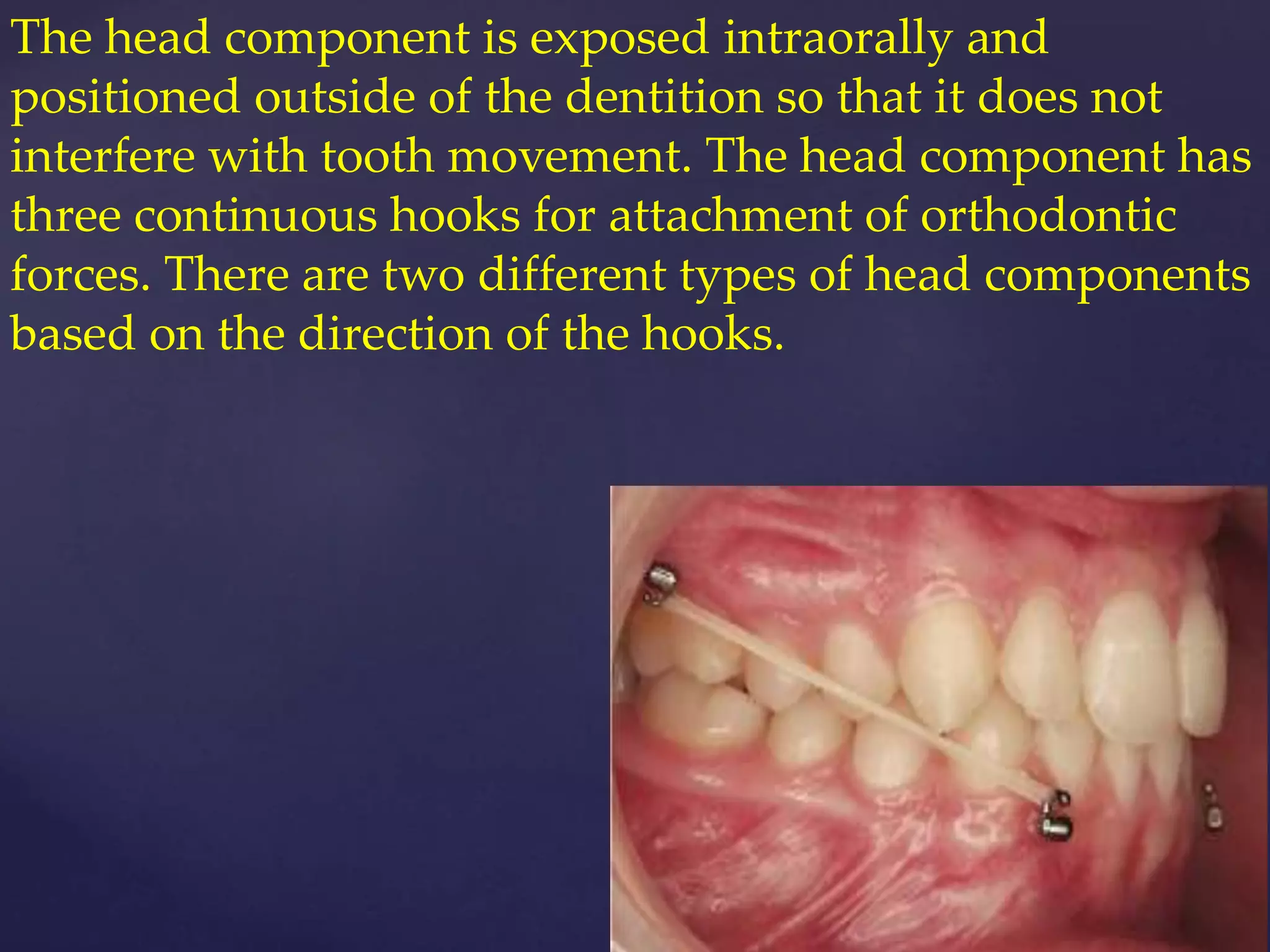 Orthodontic correction of early class iii with miniplates | PPTX