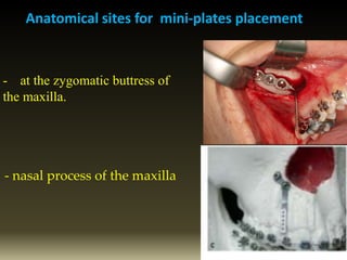 Orthodontic correction of early class iii with miniplates | PPTX
