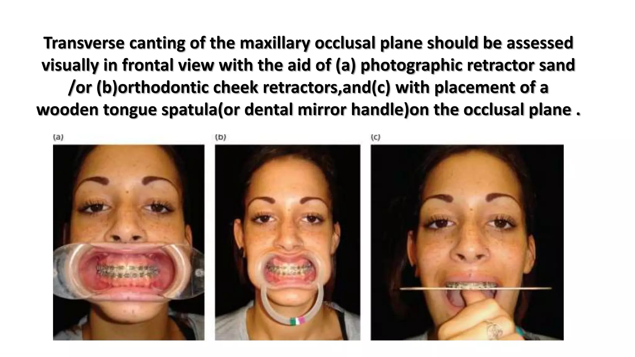 Orthodontic correction of occlusal plane canting part 1 | PPTX | Dental Health | Diseases and ...