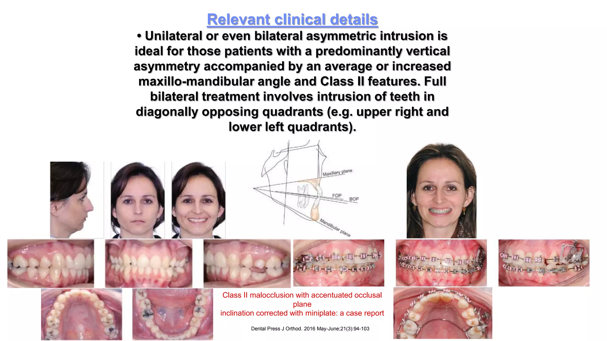 Orthodontic correction of occlusal plane canting part 1 | PPTX | Dental Health | Diseases and ...