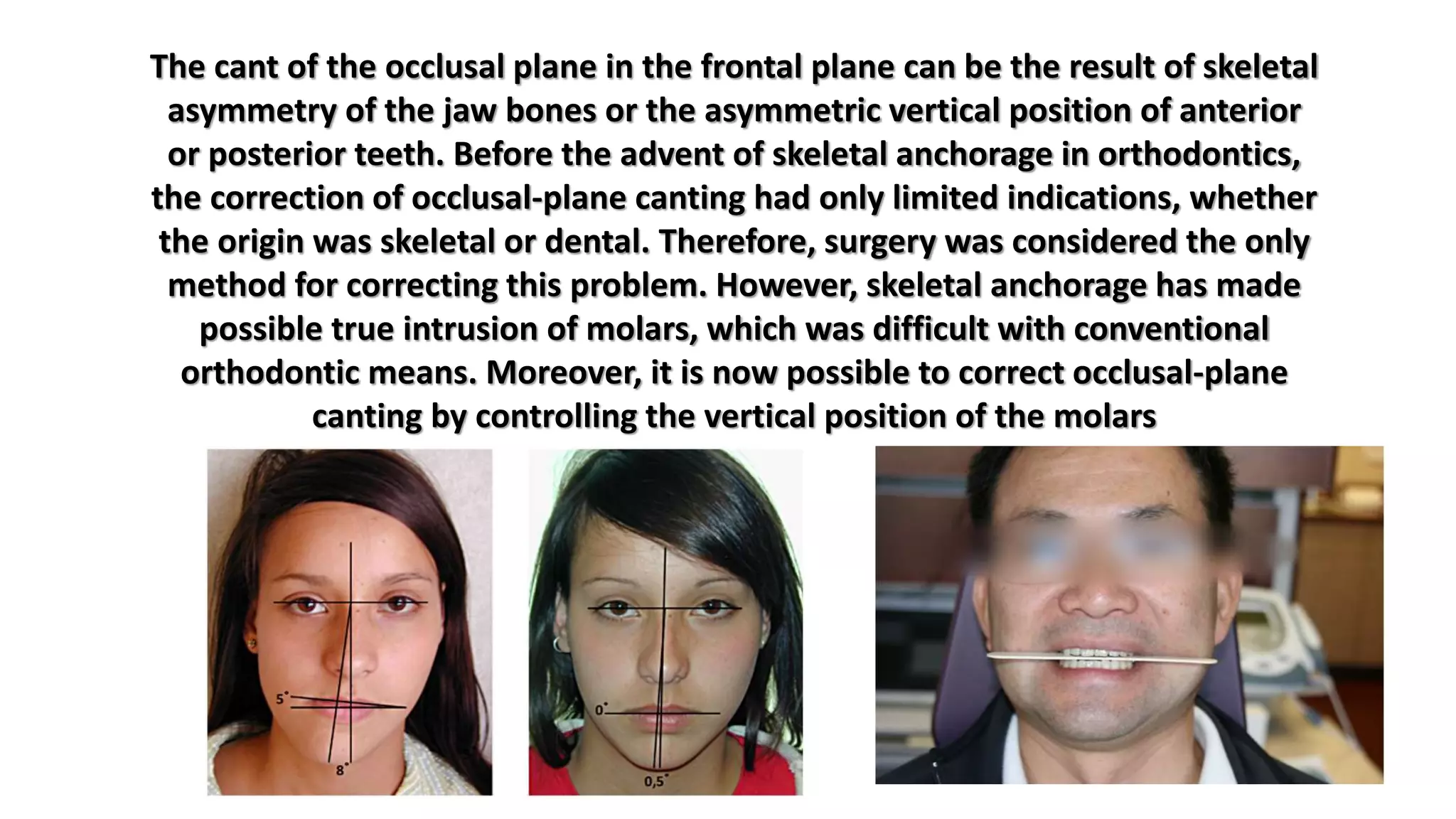 Orthodontic correction of occlusal plane canting part 1 | PPTX | Dental Health | Diseases and ...