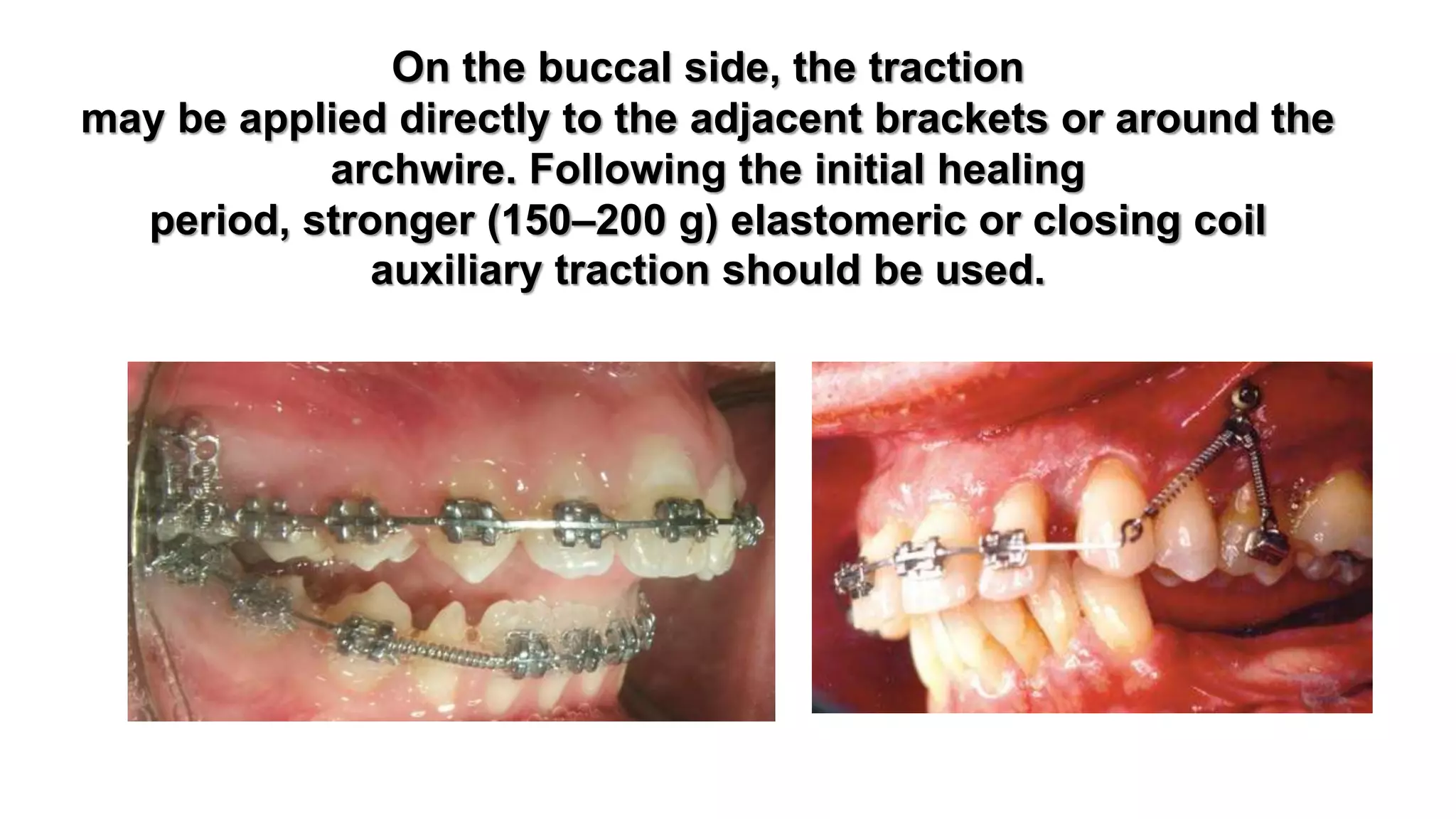 Orthodontic correction of occlusal plane canting part 1 | PPTX