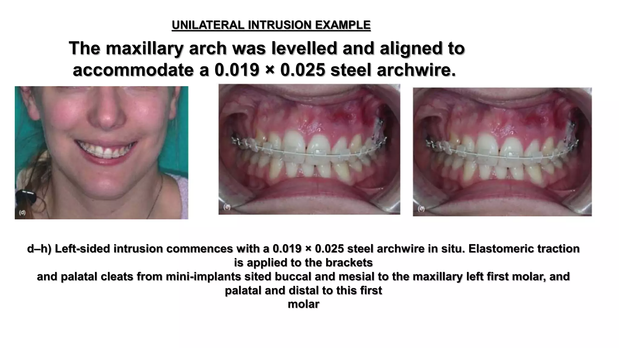 Orthodontic correction of occlusal plane canting part 1 | PPTX