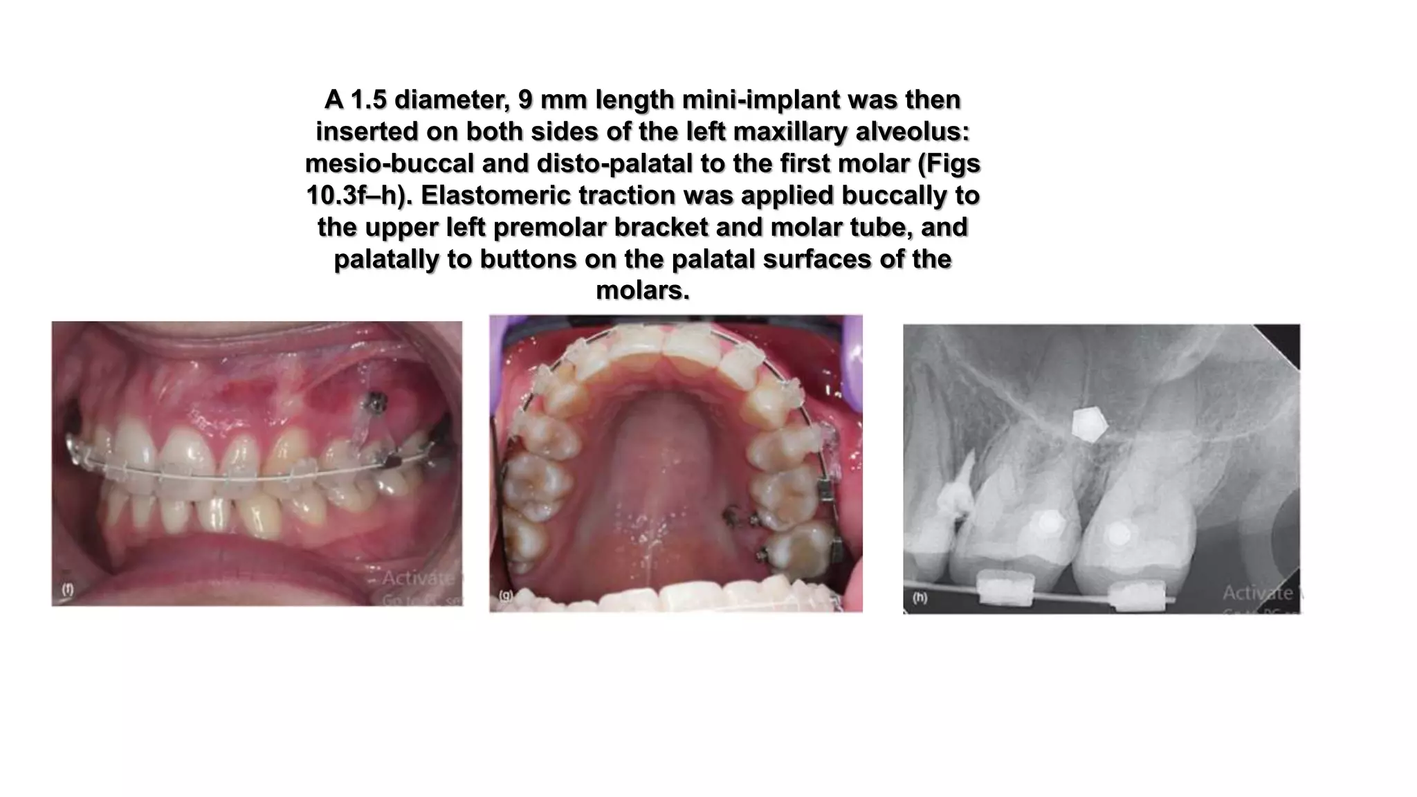 Orthodontic correction of occlusal plane canting part 1 | PPTX