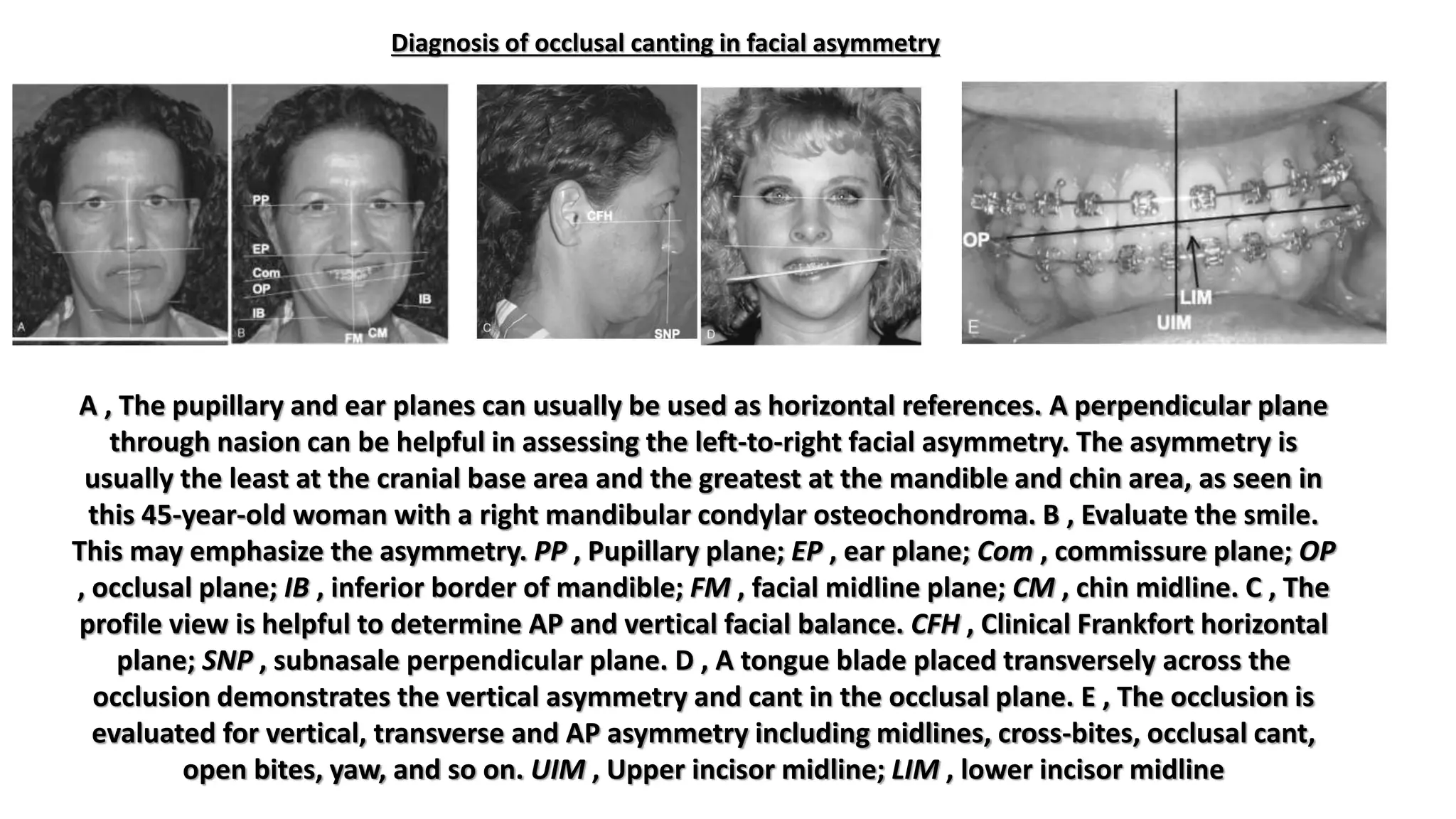 Orthodontic correction of occlusal plane canting part 1 | PPTX | Dental Health | Diseases and ...
