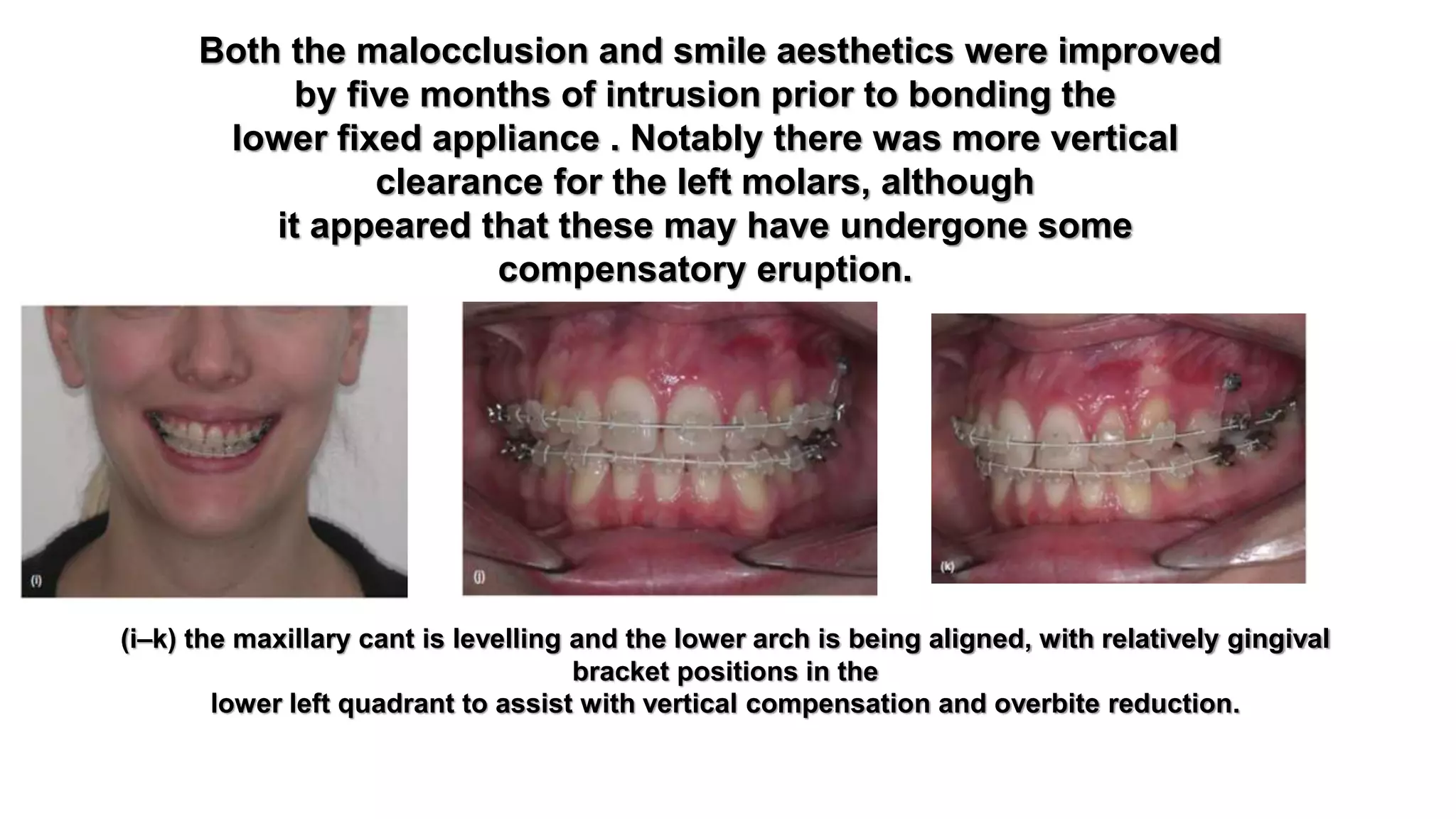 Orthodontic correction of occlusal plane canting part 1 | PPTX