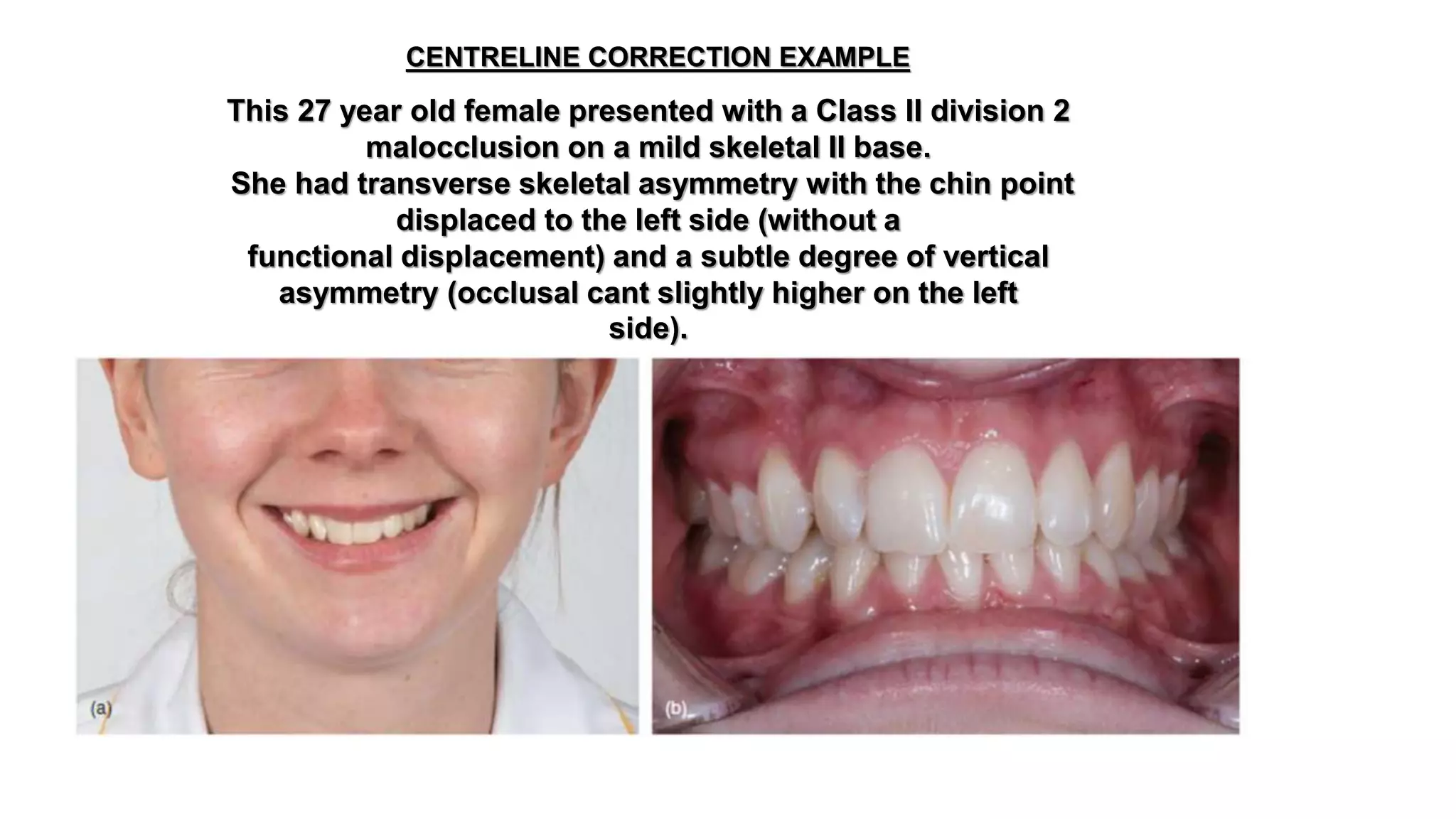Orthodontic correction of occlusal plane canting part 1 | PPTX
