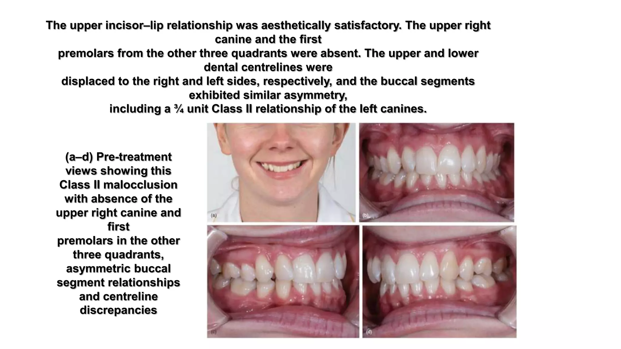 Orthodontic correction of occlusal plane canting part 1 | PPTX