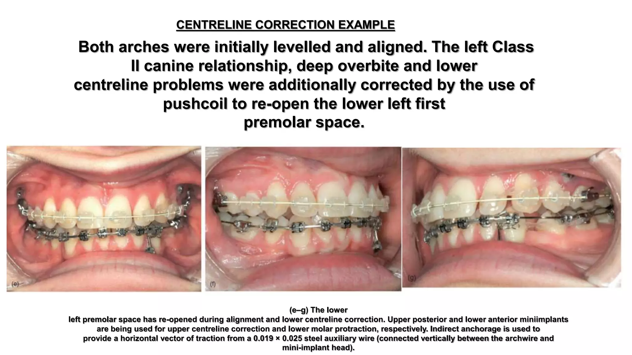 Orthodontic correction of occlusal plane canting part 1 | PPTX
