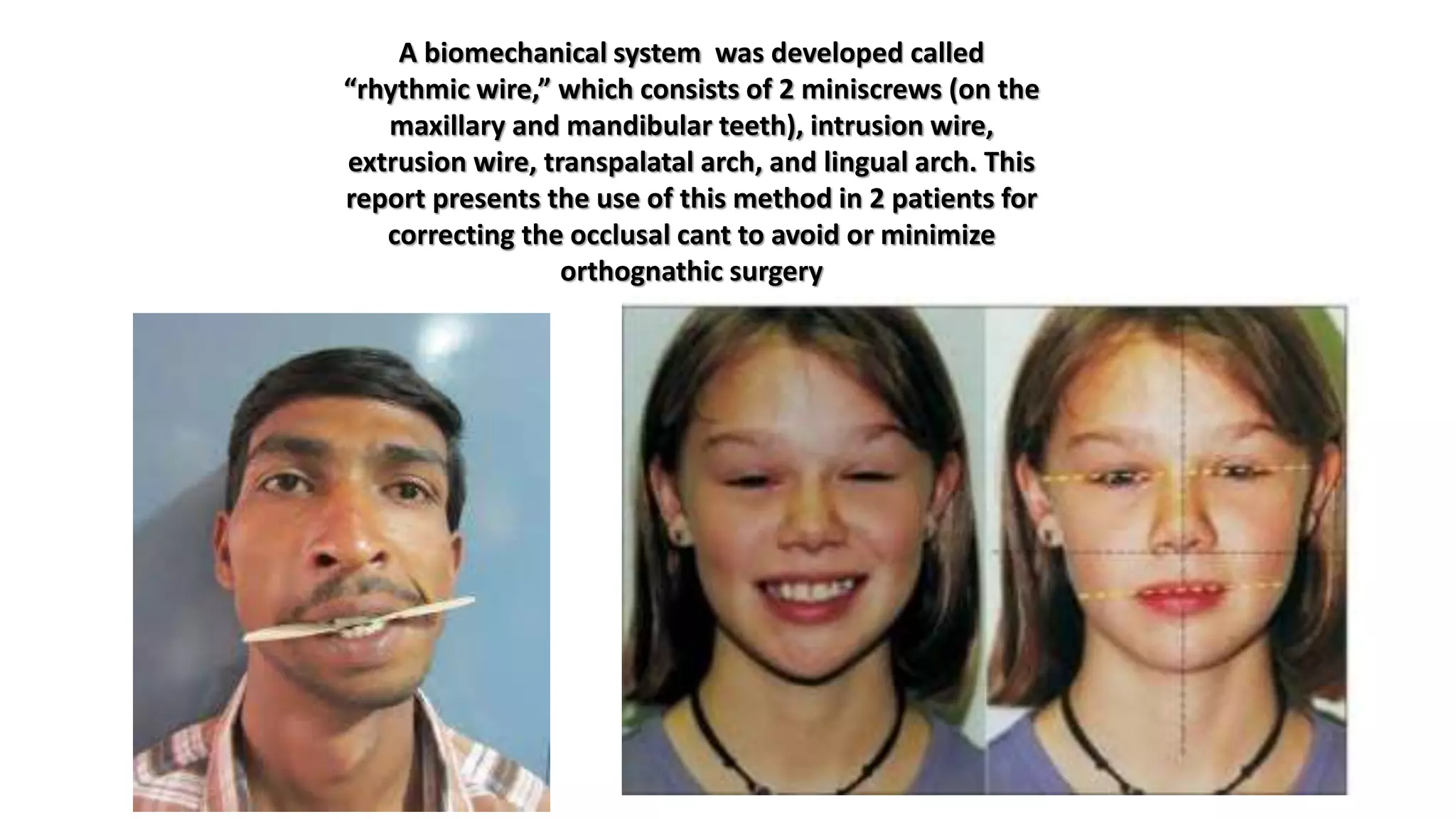 Orthodontic correction of occlusal plane canting part 1 | PPTX
