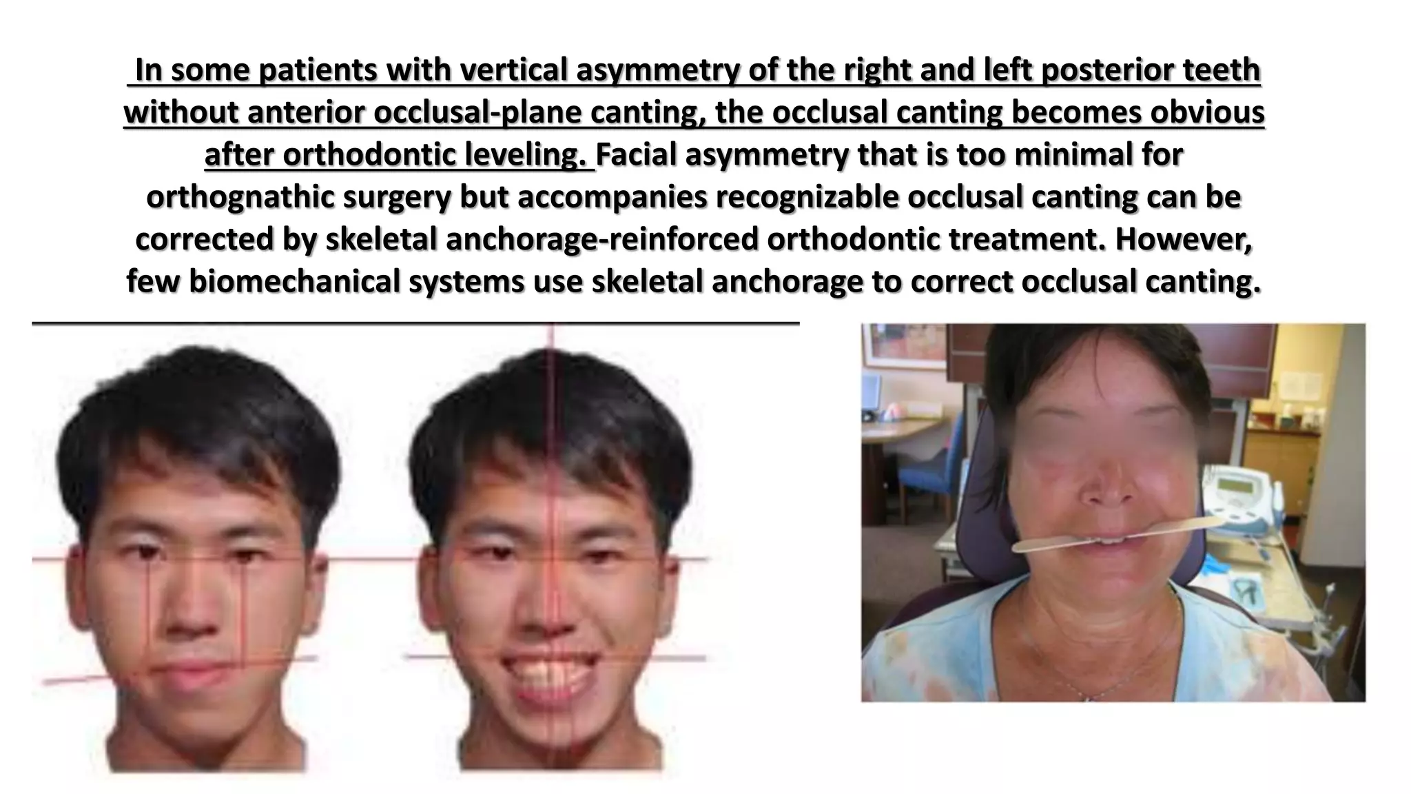 Orthodontic correction of occlusal plane canting part 1 | PPTX | Dental Health | Diseases and ...