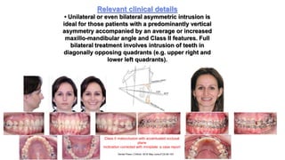Orthodontic correction of occlusal plane canting part 1 | PPTX
