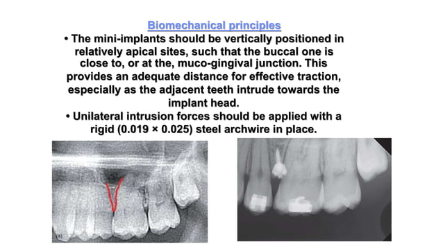 Orthodontic correction of occlusal plane canting part 1 | PPTX | Dental ...