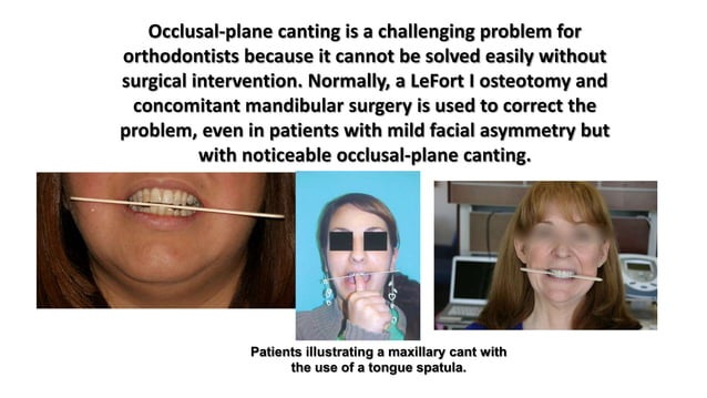 Orthodontic correction of occlusal plane canting part 1 | PPTX | Dental Health | Diseases and ...