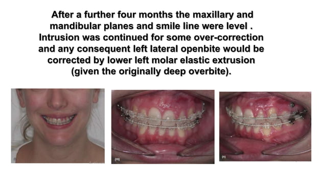 Orthodontic correction of occlusal plane canting part 1 | PPTX | Dental ...