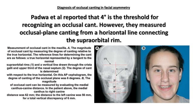 Orthodontic correction of occlusal plane canting part 1 | PPTX | Dental ...