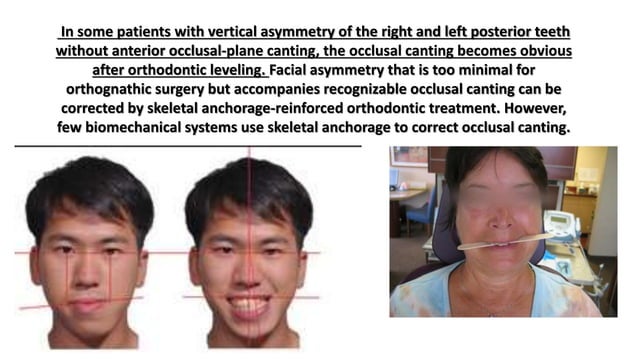 Orthodontic correction of occlusal plane canting part 1 | PPTX | Dental ...