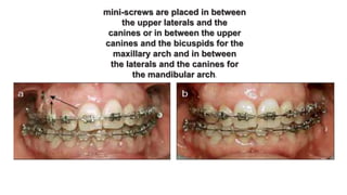 Orthodontic correction of occlusal plane canting part 1 | PPTX
