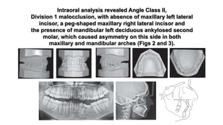 Orthodontic correction of occlusal plane canting part 1 | PPTX