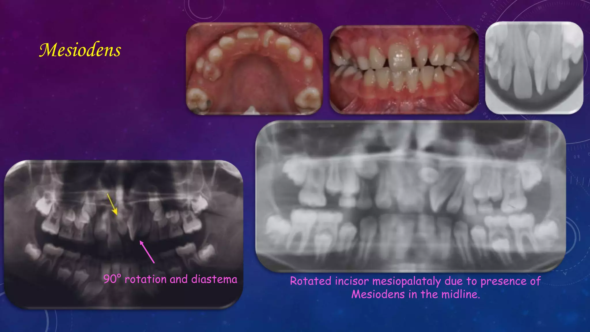 Orthodontic Correction of Rotated Teeth | PPTX | Dental Health ...