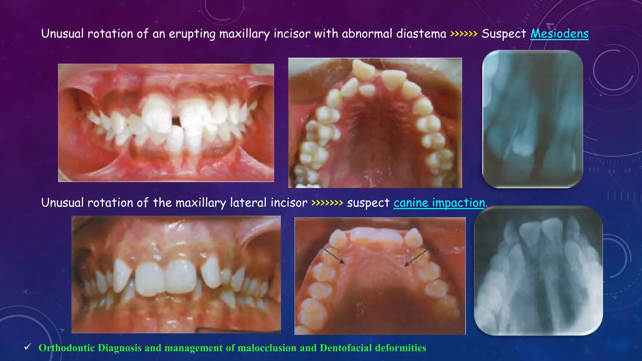 Orthodontic Correction of Rotated Teeth | PPTX
